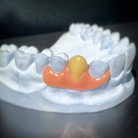 CLEARsplint – Zahntechnik Jonas